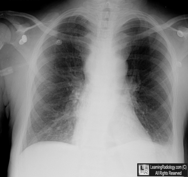 LearningRadiology - esophageal, duplication, cyst, foregut, middle ...