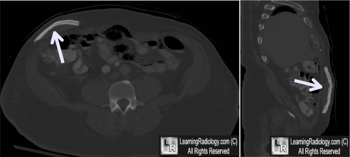 Skull Flap Implanted in Abdominal Wall | ARYAN'S BLOG