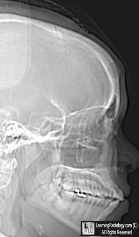 LearningRadiology - Dermoid, Skull, Epidermoid, Inclusion, Cyst ...