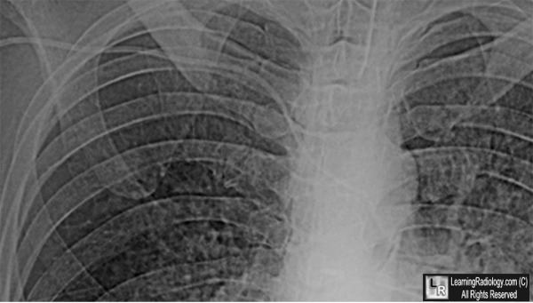 LearningRadiology - Arterial, Placement, CVP, CVC, Central, Venous ...
