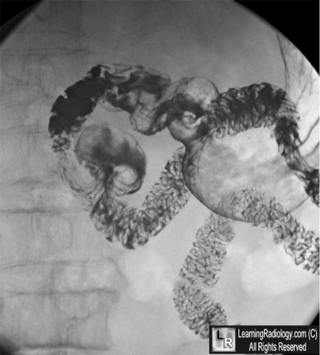 LearningRadiology - duodenal, diverticulum, tic, duodenum, radiology ...