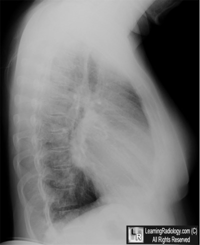 LearningRadiology - mitral, stenosis, ms, stenotic, valve, rheumatic ...