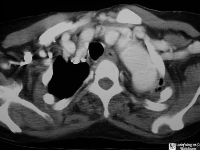LearningRadiology - cervical, high, aortic, arch, anomaly, anomalous ...