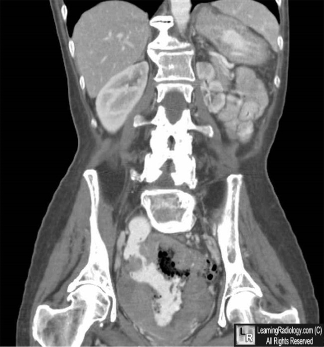 LearningRadiology - lymphoma, small, bowel, intestine, lymphosarcoma ...