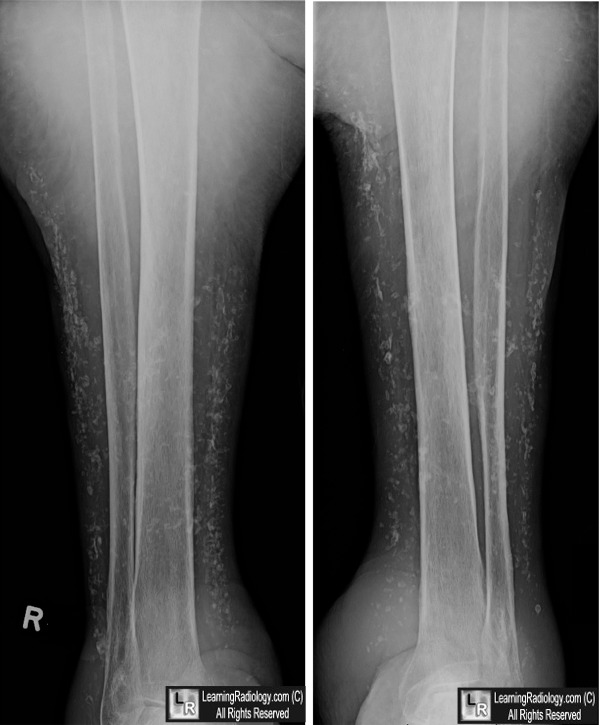 LearningRadiology - Chronic Venous Insufficiency