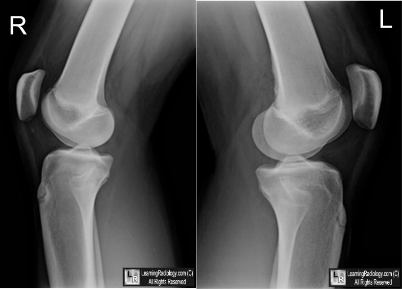 LearningRadiology - Cortical Desmoid, Distal, Femoral, Metaphyseal ...
