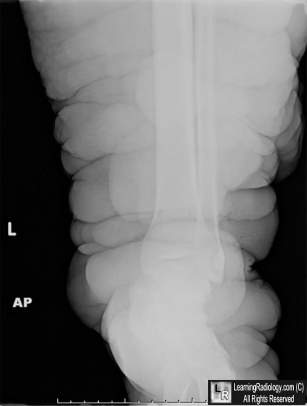 LearningRadiology - lymphedema, radiology, imaging