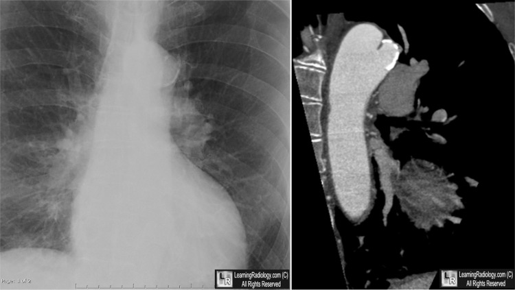 LearningRadiology - ductus, diverticulum, tic, bump, radiology