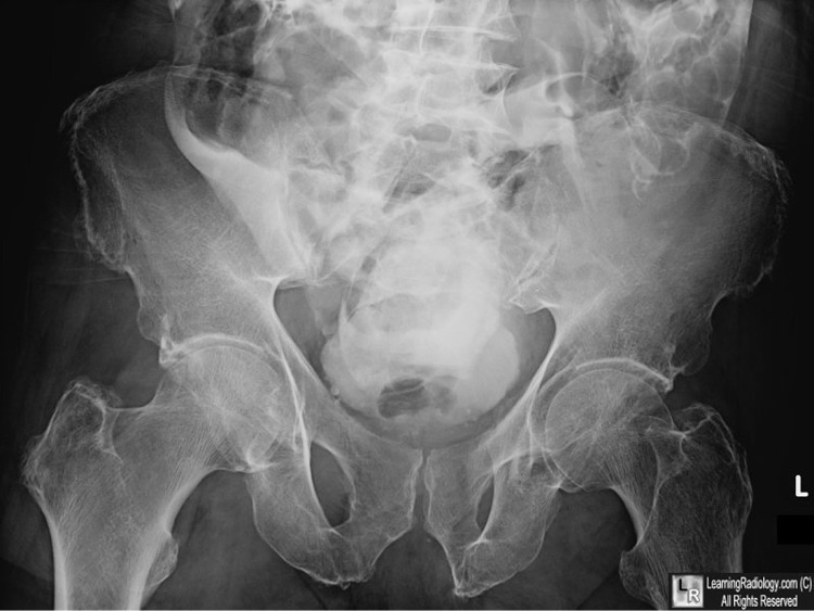 LearningRadiology - Bladder, Rupture,Intraperitoneal, perforation ...