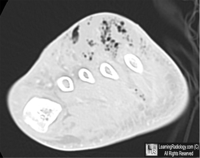 LearningRadiology - Necrotizing Fasciitis