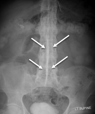 Learning Radiology - Dagger Sign, Ankylosing Spondylitis