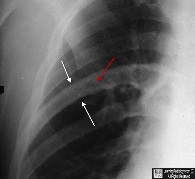 Learning Radiology - Paget Disease of the Rib