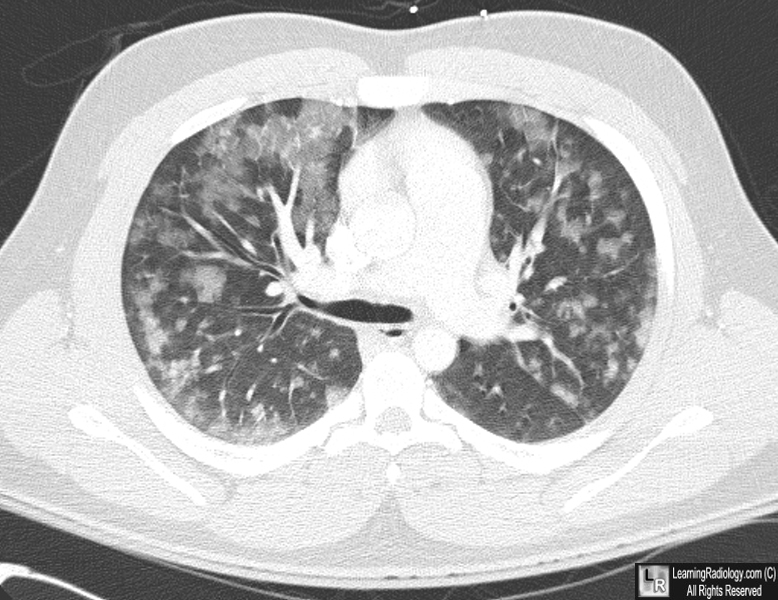 Learning Radiology - Archives 2017