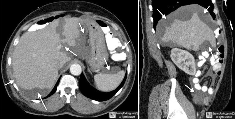 LearningRadiology - Pseudomyxoma Peritonei