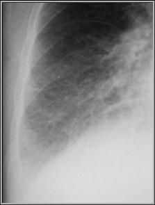 LearningRadiology - Congestive Heart Failure, CHF