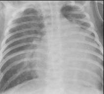 LearningRadiology- Cyanotic Heart Disease