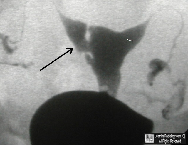 Welcome to LearningRadiology - radiology, radiologic, imaging, signs ...