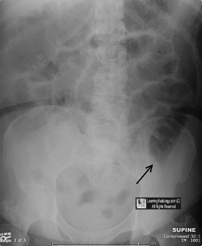 Welcome to LearningRadiology - radiology, radiologic, imaging, sign ...