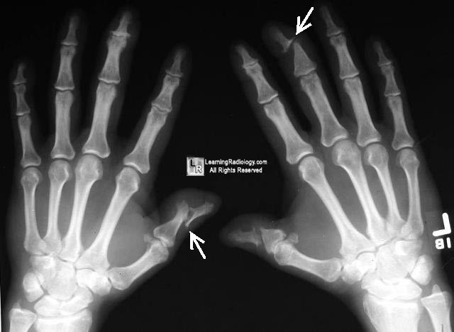 Welcome to LearningRadiology - radiology, radiologic, imaging, sign ...