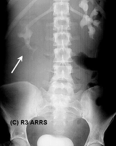 Welcome to LearningRadiology - radiology, radiologic, imaging, sign ...