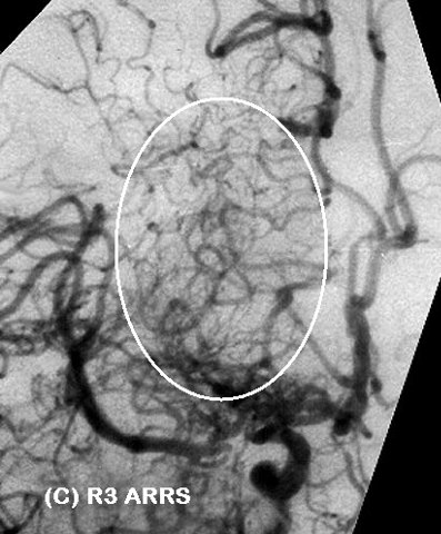 Welcome to LearningRadiology - radiology, radiologic, imaging, sign ...